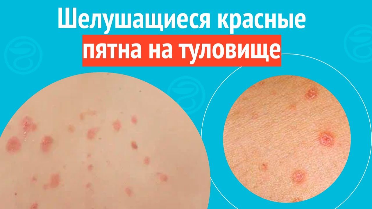 🥺 Шелушащиеся красные пятна на туловище. Клинический случай №1586