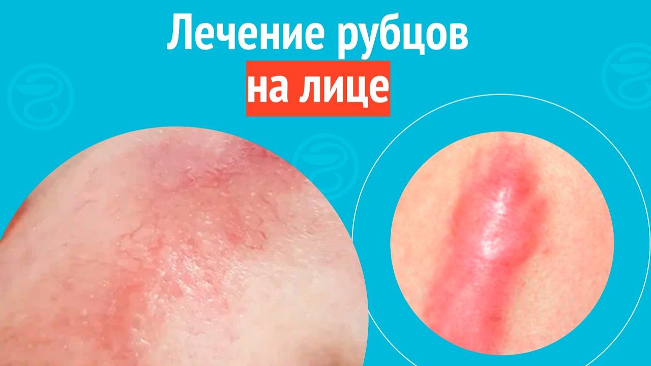 👃 Лечение рубцов на лице. Клинический случай №1591