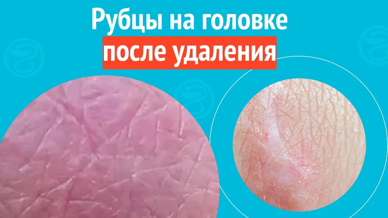 ➡️ Рубцы на головке после удаления. Клинический случай №1602