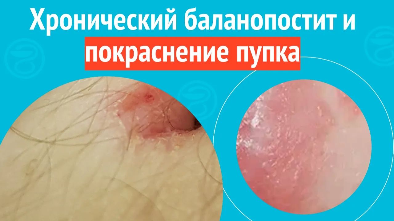 😮 Хронический баланопостит и покраснение пупка. Клинический случай №1597