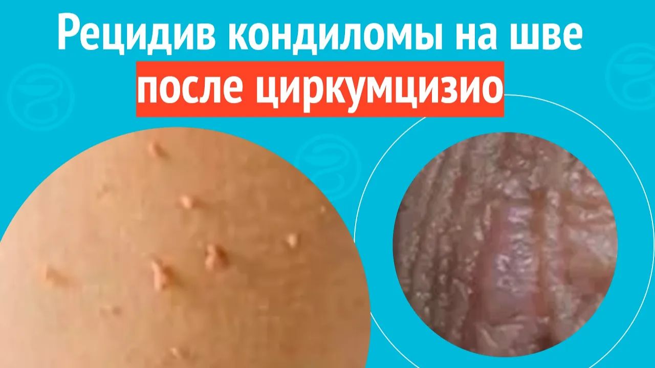 😰 Рецидив кондиломы на шве после циркумцизио. Клинический случай №1601
