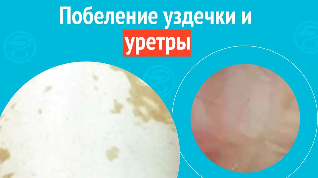 👉 Побеление уздечки и уретры. Клинический случай №1596