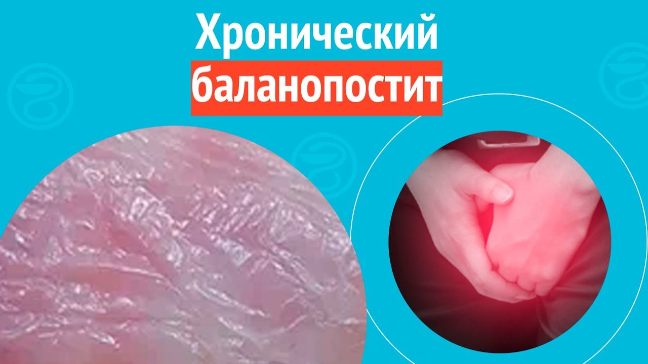 🥺 Хронический баланопостит. Клинический случай №1606
