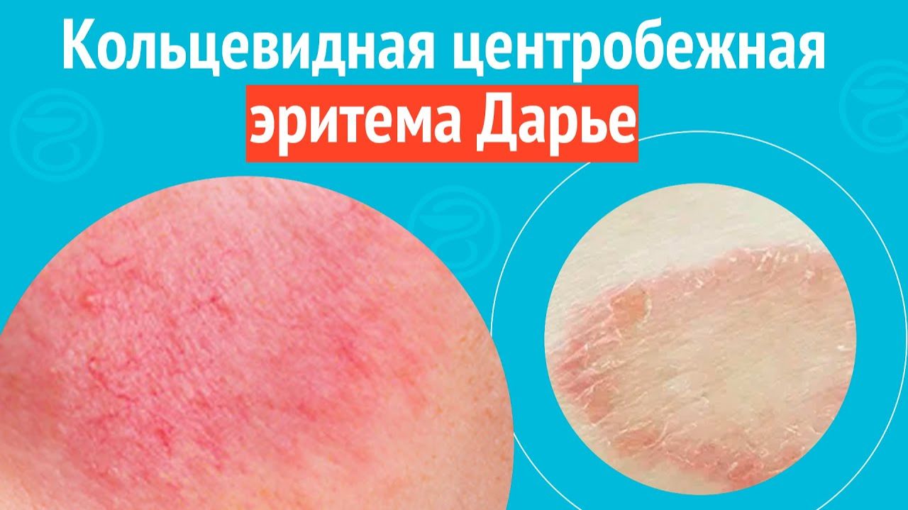 💍 Кольцевидная центробежная эритема Дарье. Клинический случай №1581