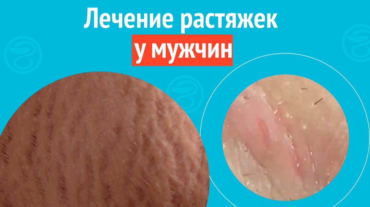 👉 Лечение растяжек у мужчин. Клинический случай №1578