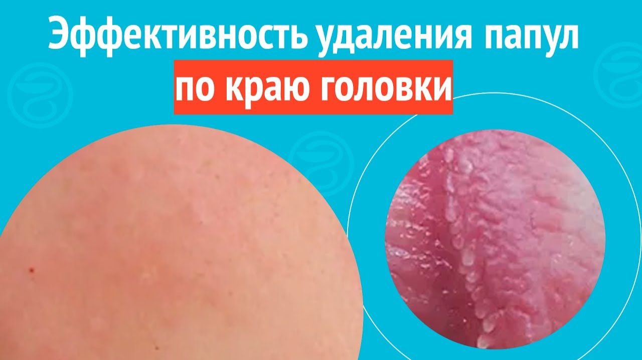 ✅ Эффективность удаления папул по краю головки. Клинический случай №1616