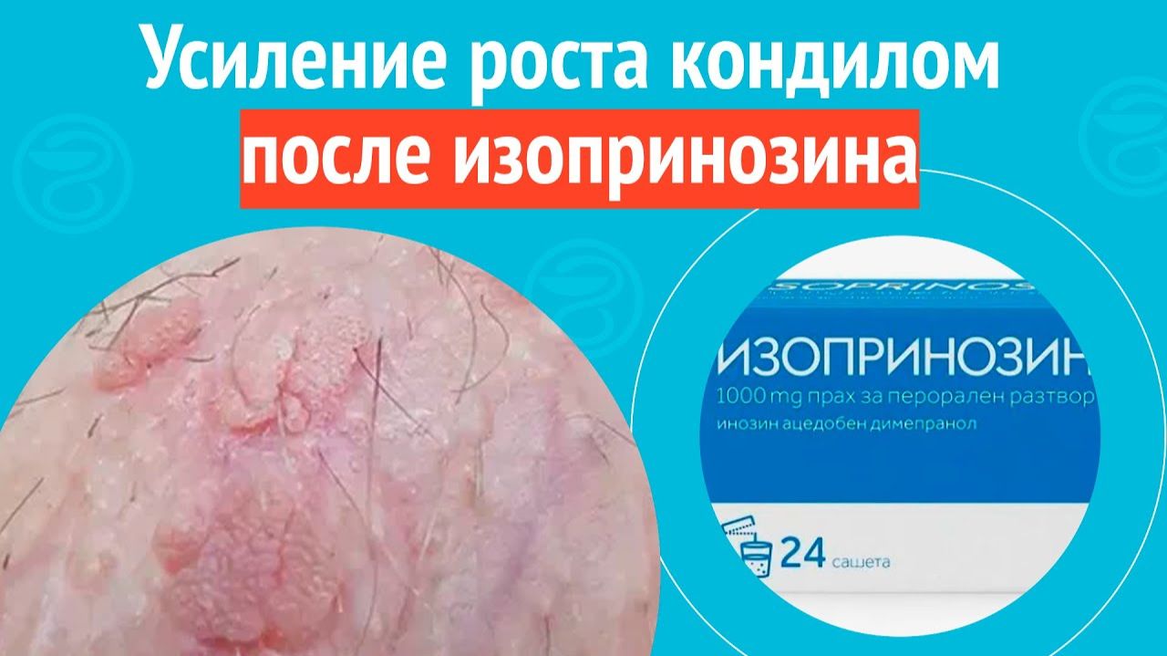 ↪ Усиление роста кондилом после изопринозина. Клинический случай №1623