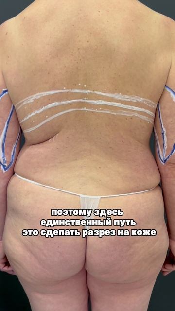 #комплексная_операция: подтяжка груди, брахиопластика и бодилифт