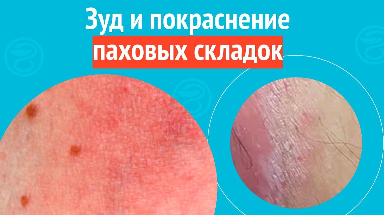 😡 Зуд и покраснение паховых складок. Клинический случай №1613