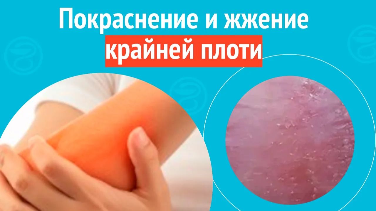 😧 Покраснение и жжение крайней плоти. Клинический случай №1608