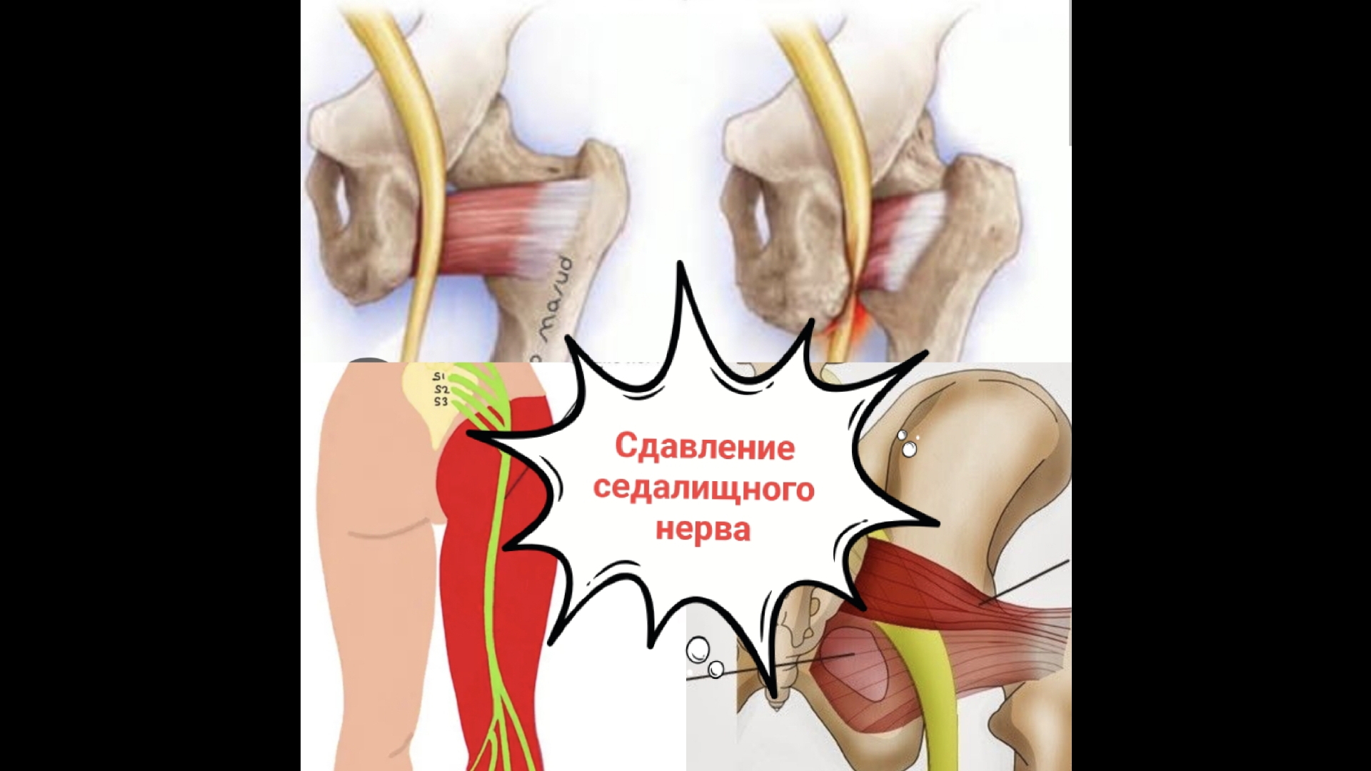 Компрессия седалищного нерва. Ишиофеморальный импиджмент.