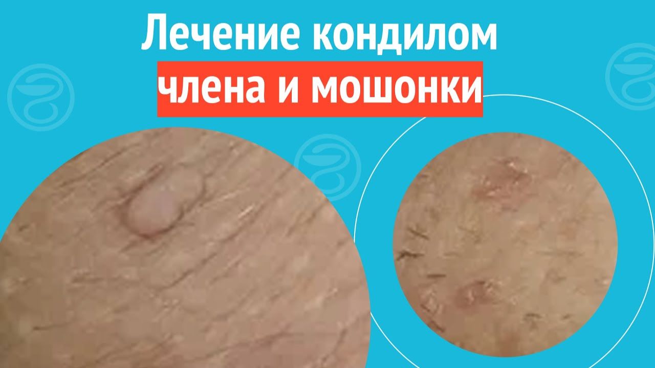 ✅ Лечение кондилом члена и мошонки. Клинический случай №1654