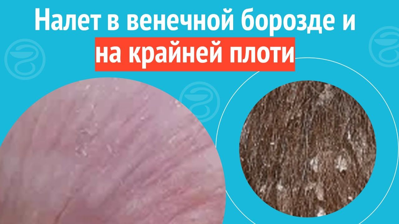 😟 Налет в венечной борозде и на крайней плоти. Клинический случай №1650