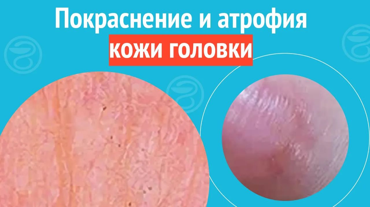 😒 Покраснение и атрофия кожи головки. Клинический случай №1660