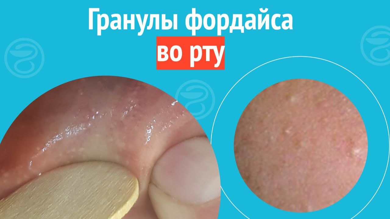 😢 Гранулы фордайса во рту. Клинический случай №1674