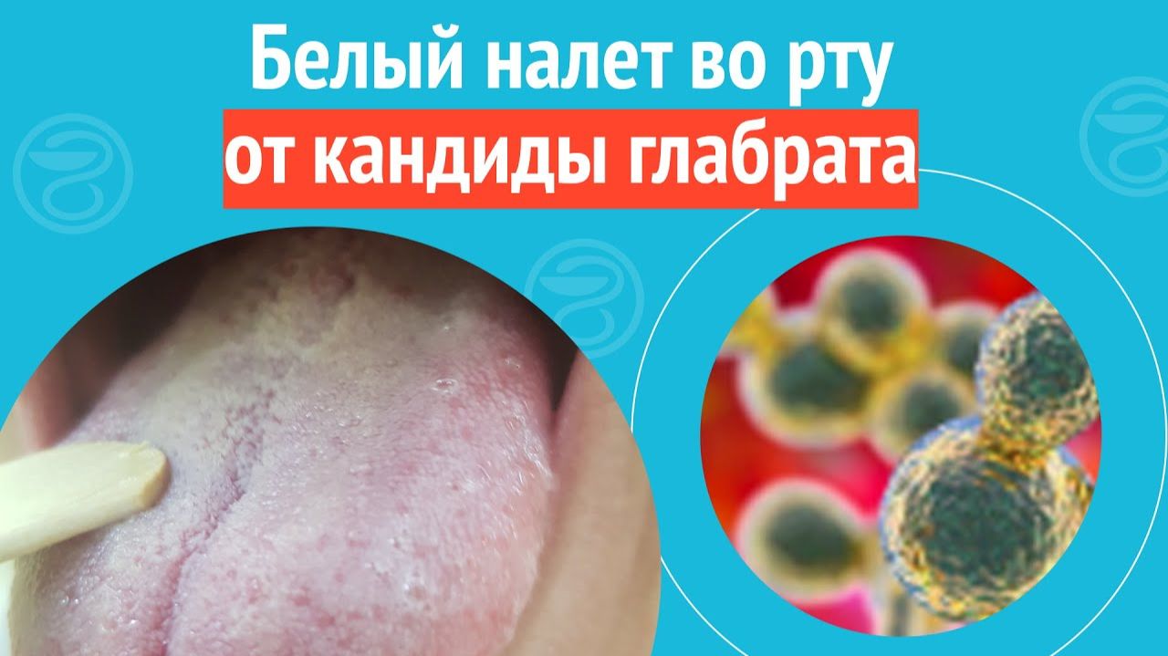 👅 Белый налет во рту от кандиды глабрата. Клинический случай №1677