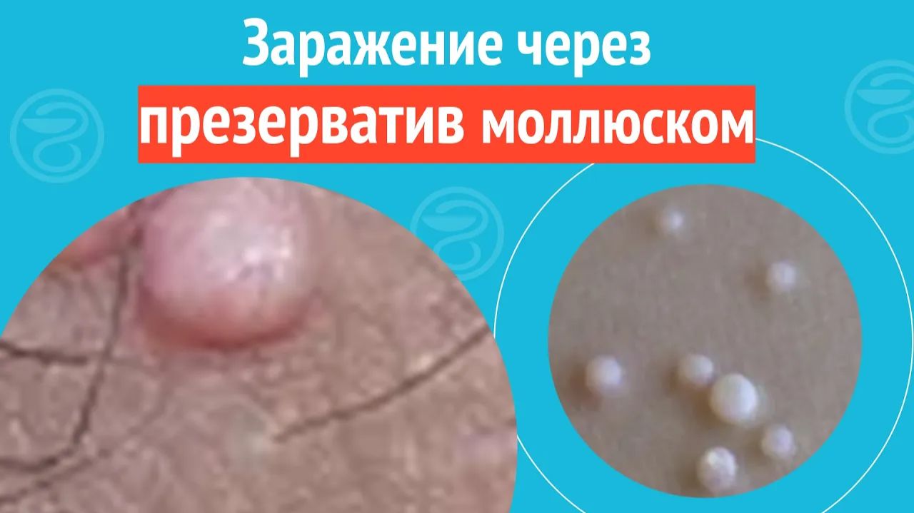 ☹️ Заражение через презерватив моллюском. Клинический случай №1662