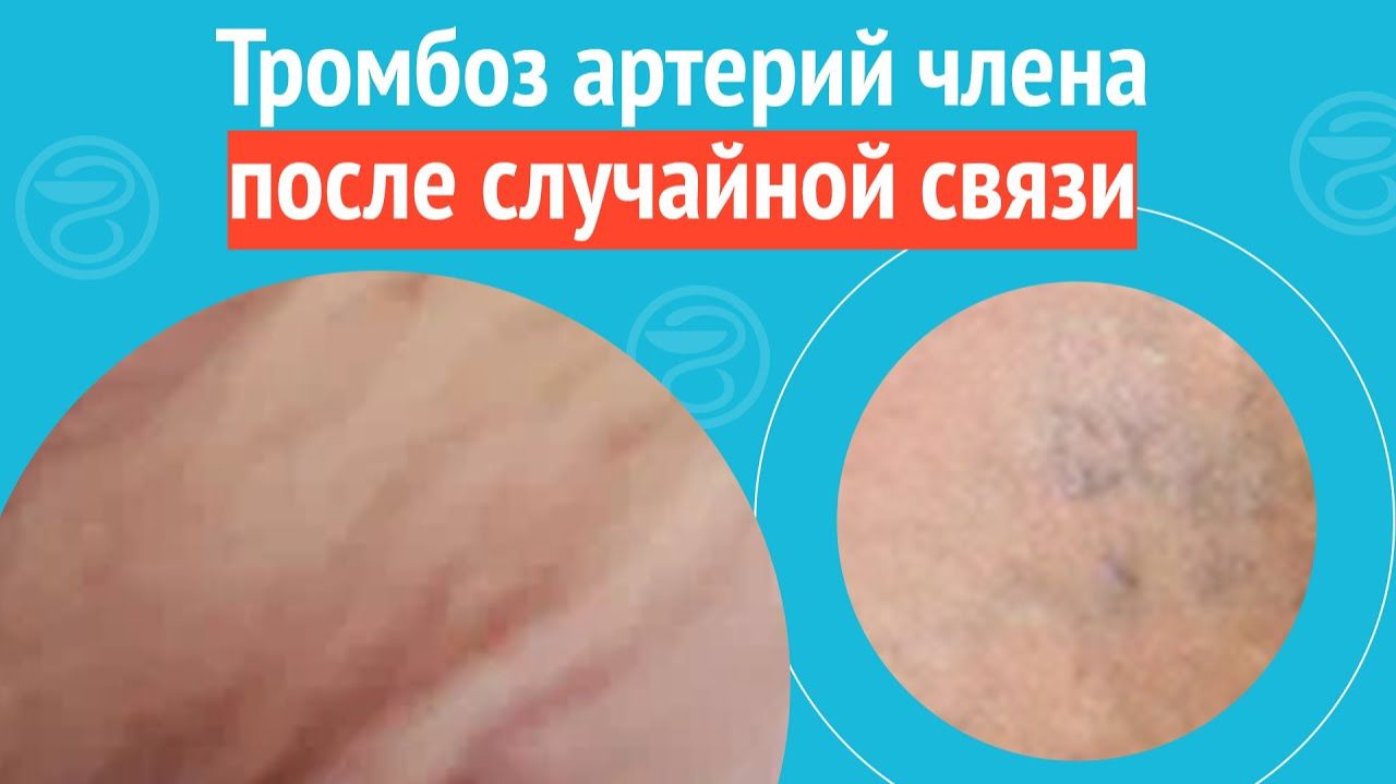 ➡️ Тромбоз артерий члена после случайной связи. Клинический случай №1665