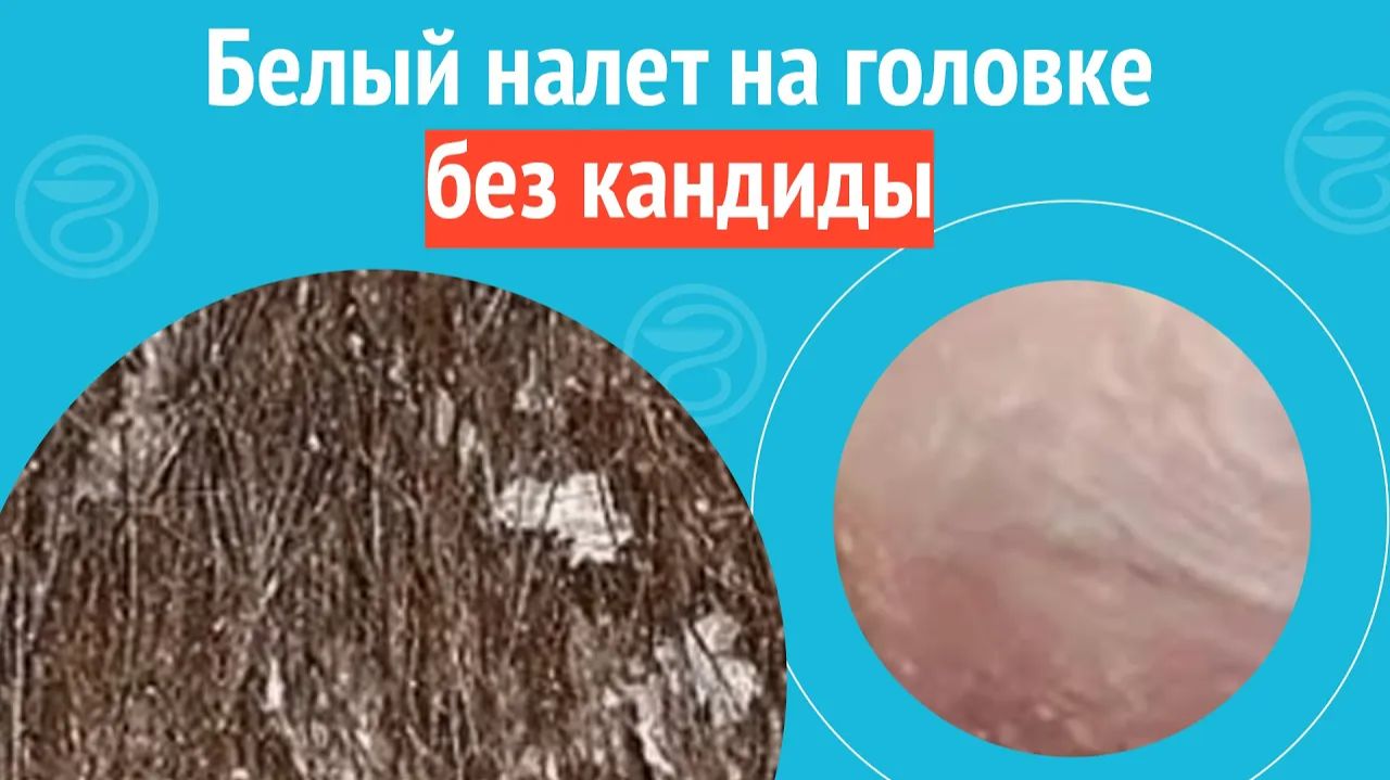 😥 Белый налет на головке без кандиды. Клинический случай №1663