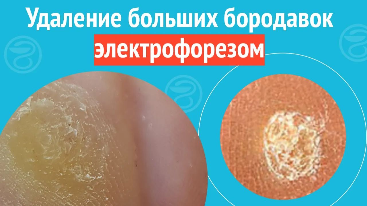 🦶 Удаление больших бородавок электрофорезом. Клинический случай №1676