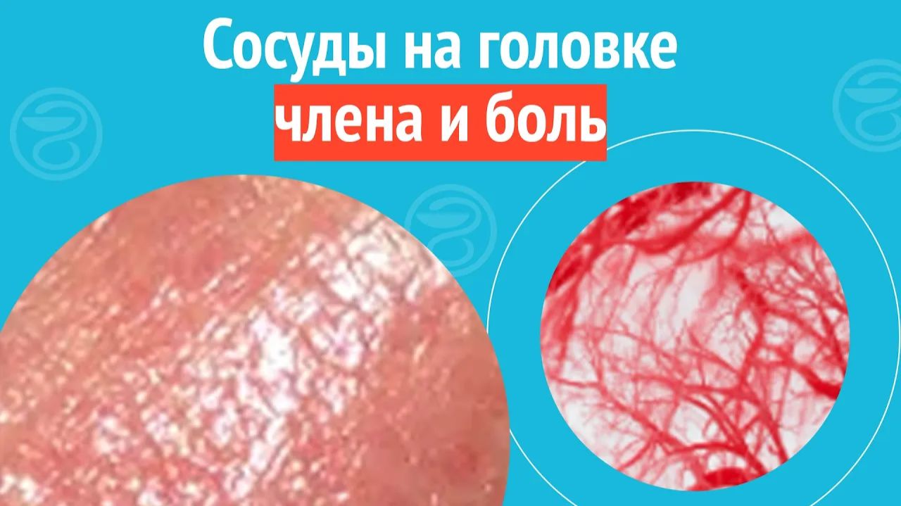 😰 Сосуды на головке члена и боль. Клинический случай №1680