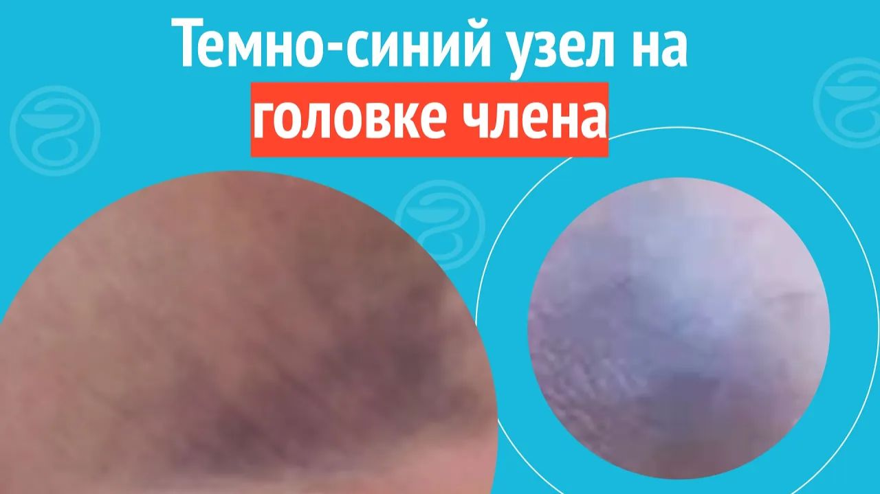 😮 Темно-синий узел на головке члена. Клинический случай №1649