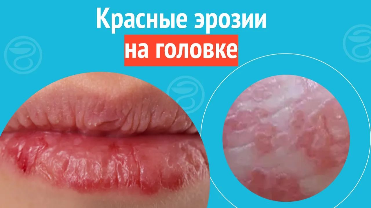 😦 Красные эрозии на головке. Клинический случай №1653