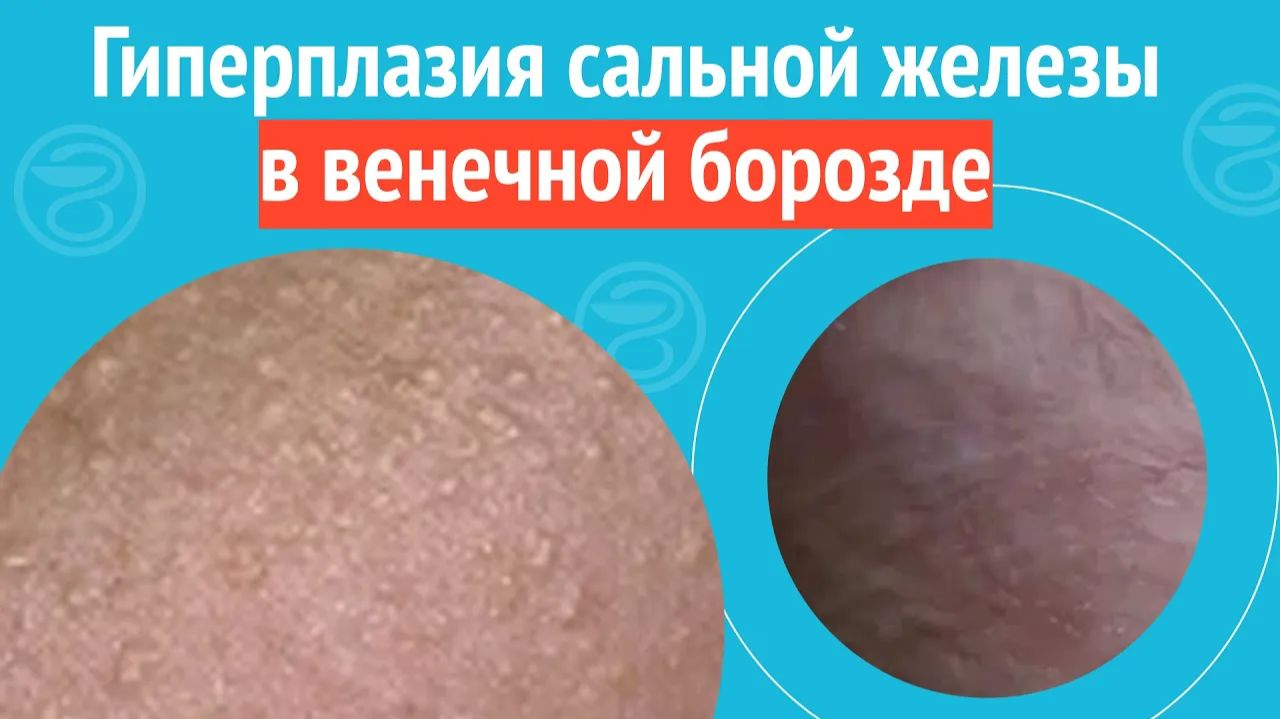 😕 Гиперплазия сальной железы в венечной борозде. Клинический случай №1668