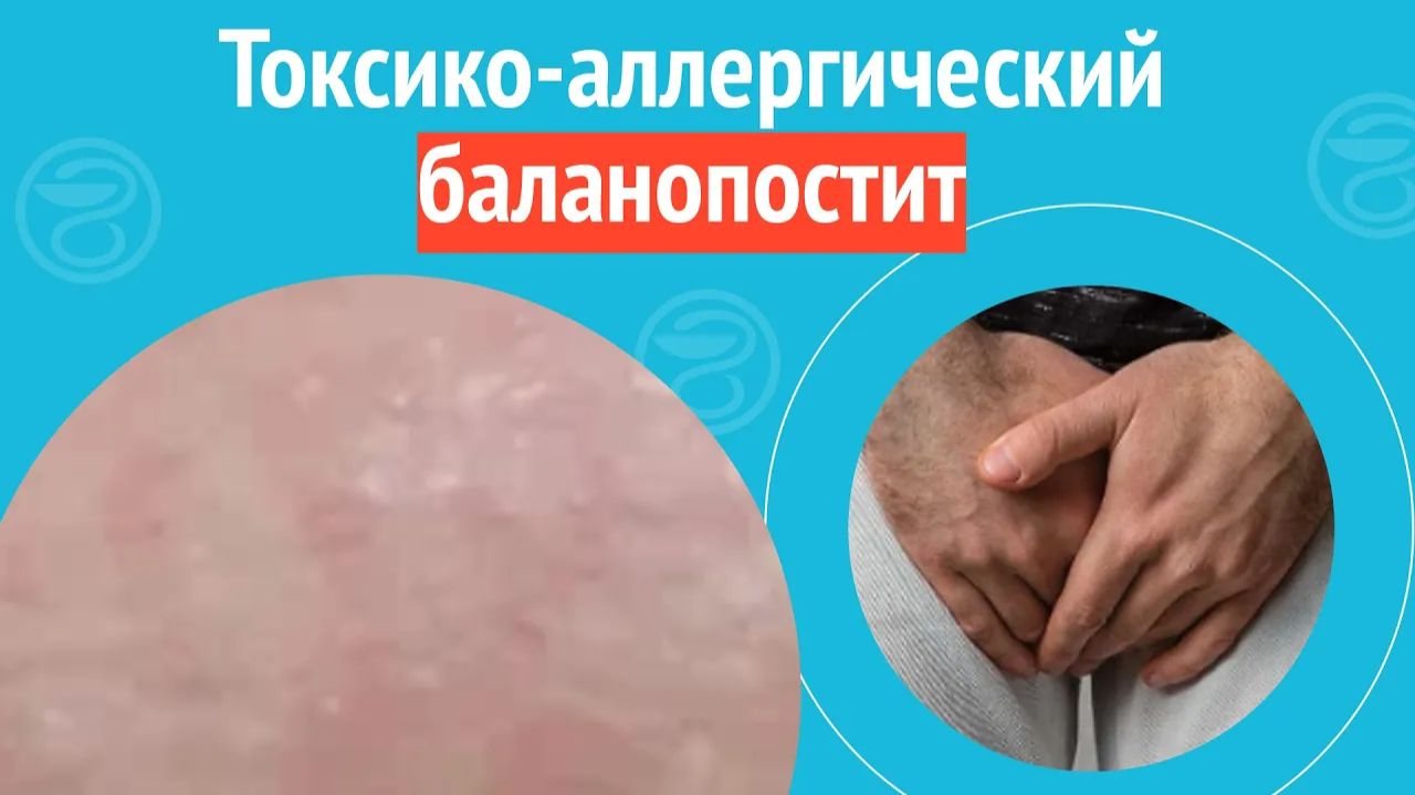😯 Токсико-аллергический баланопостит. Клинический случай №1669