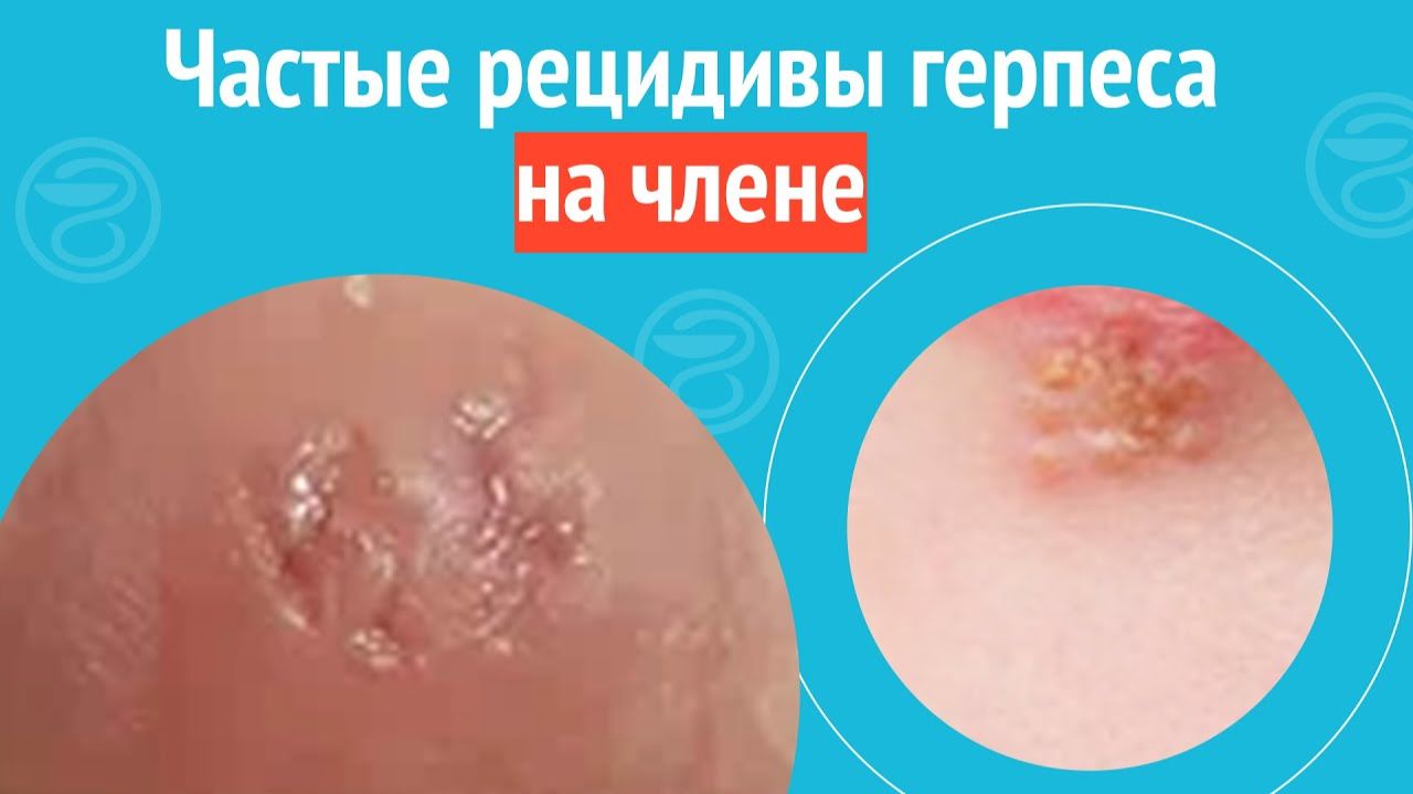 😮 Частые рецидивы герпеса на члене. Клинический случай №1667
