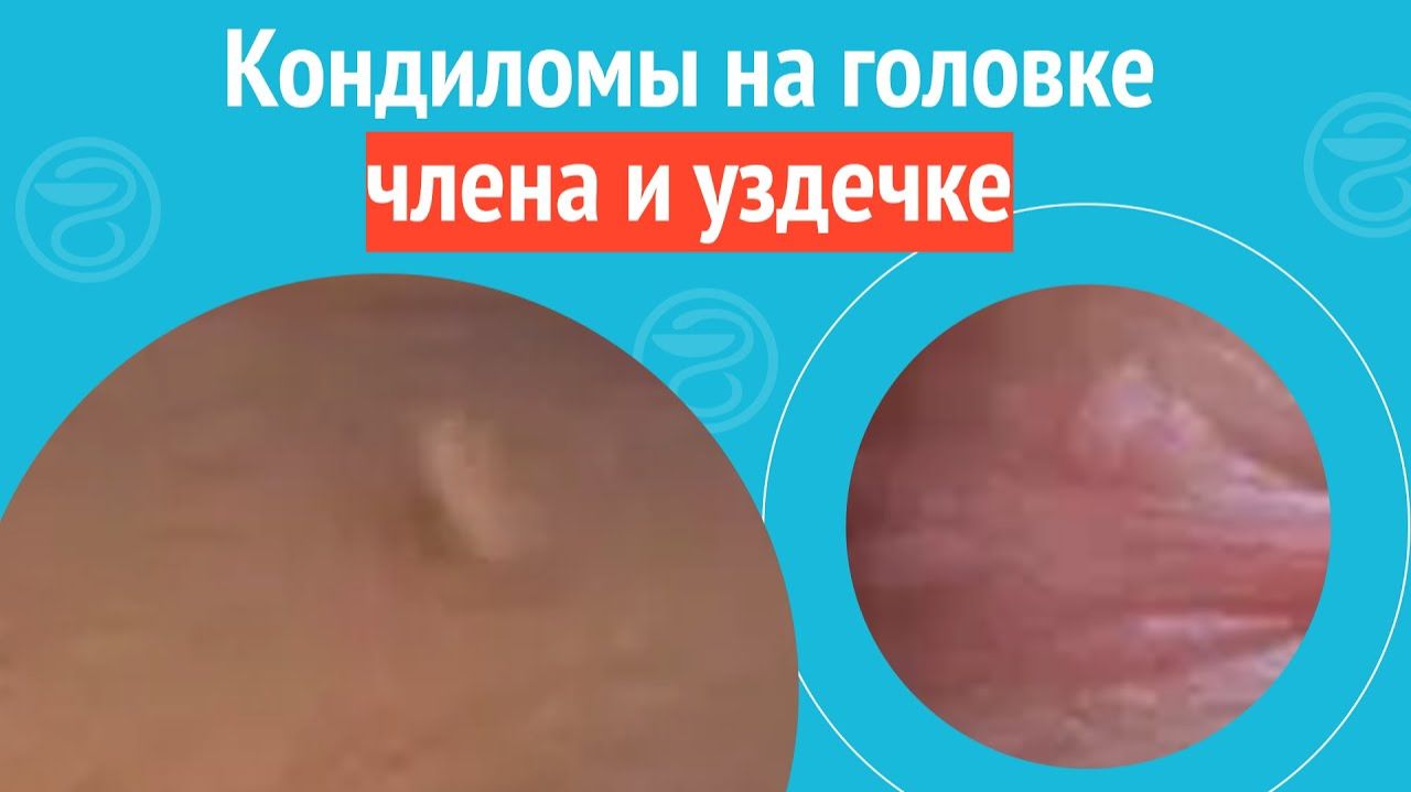 🥺 Кондиломы на головке члена и уздечке. Клинический случай №1670