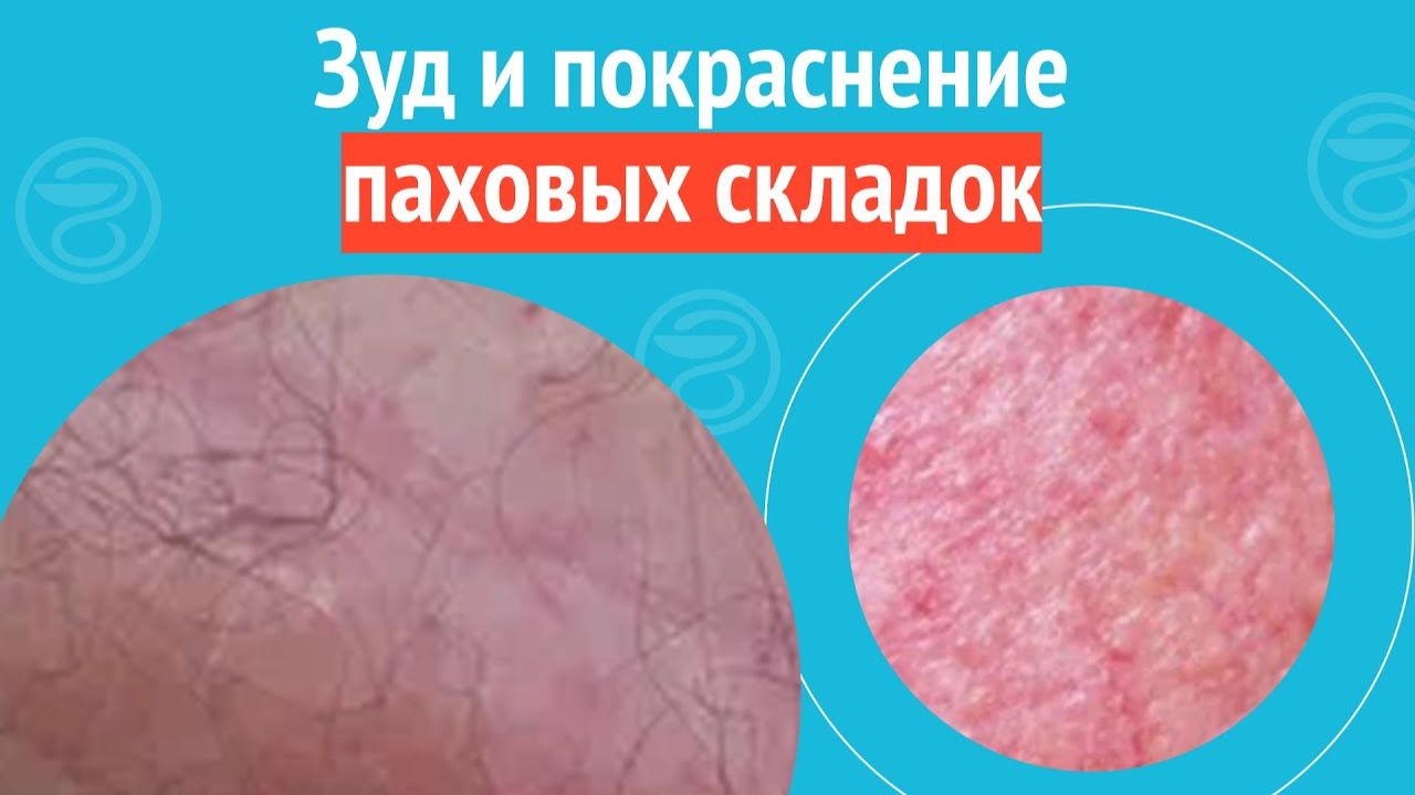 😡 Зуд и покраснение паховых складок. Клинический случай №1655