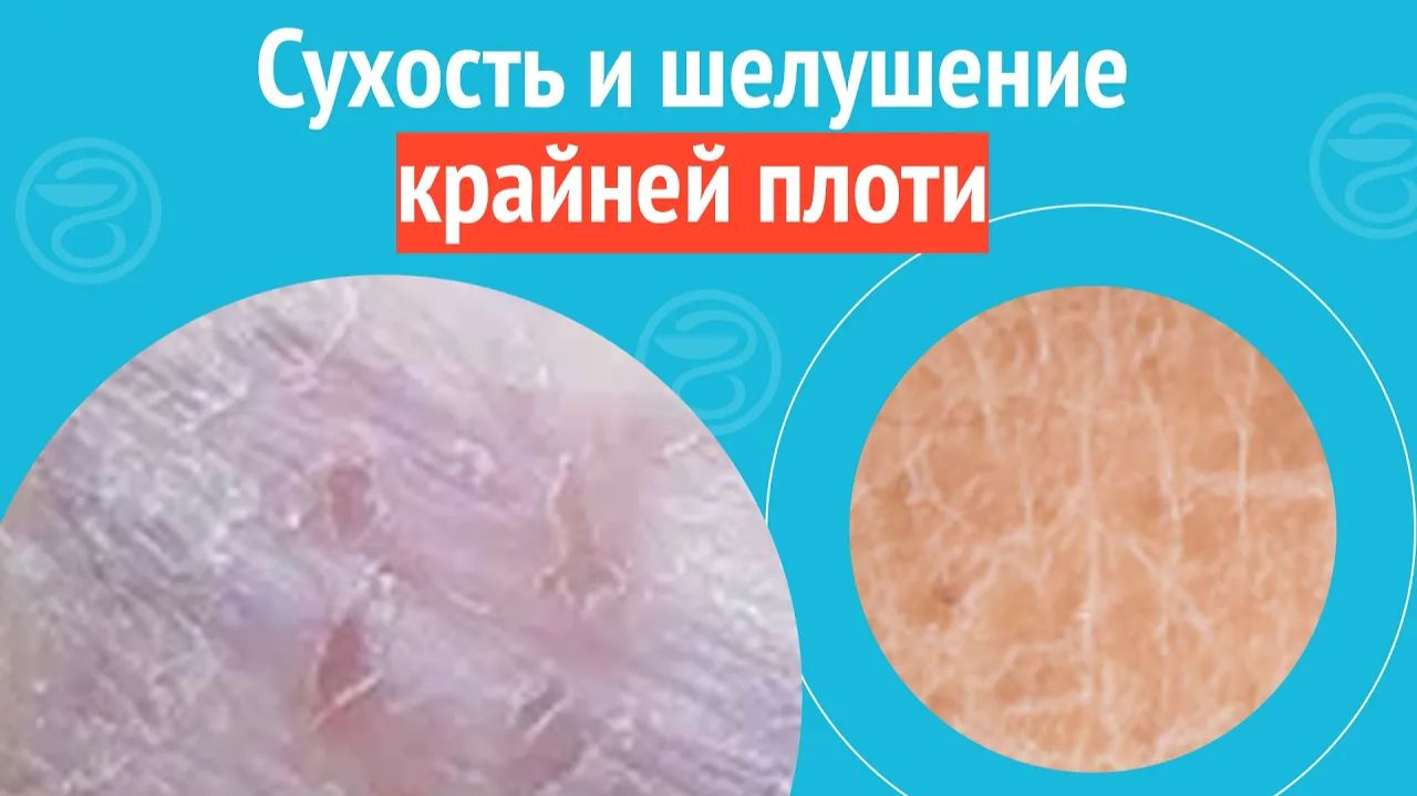 👉 Сухость и шелушение крайней плоти. Клинический случай №1681