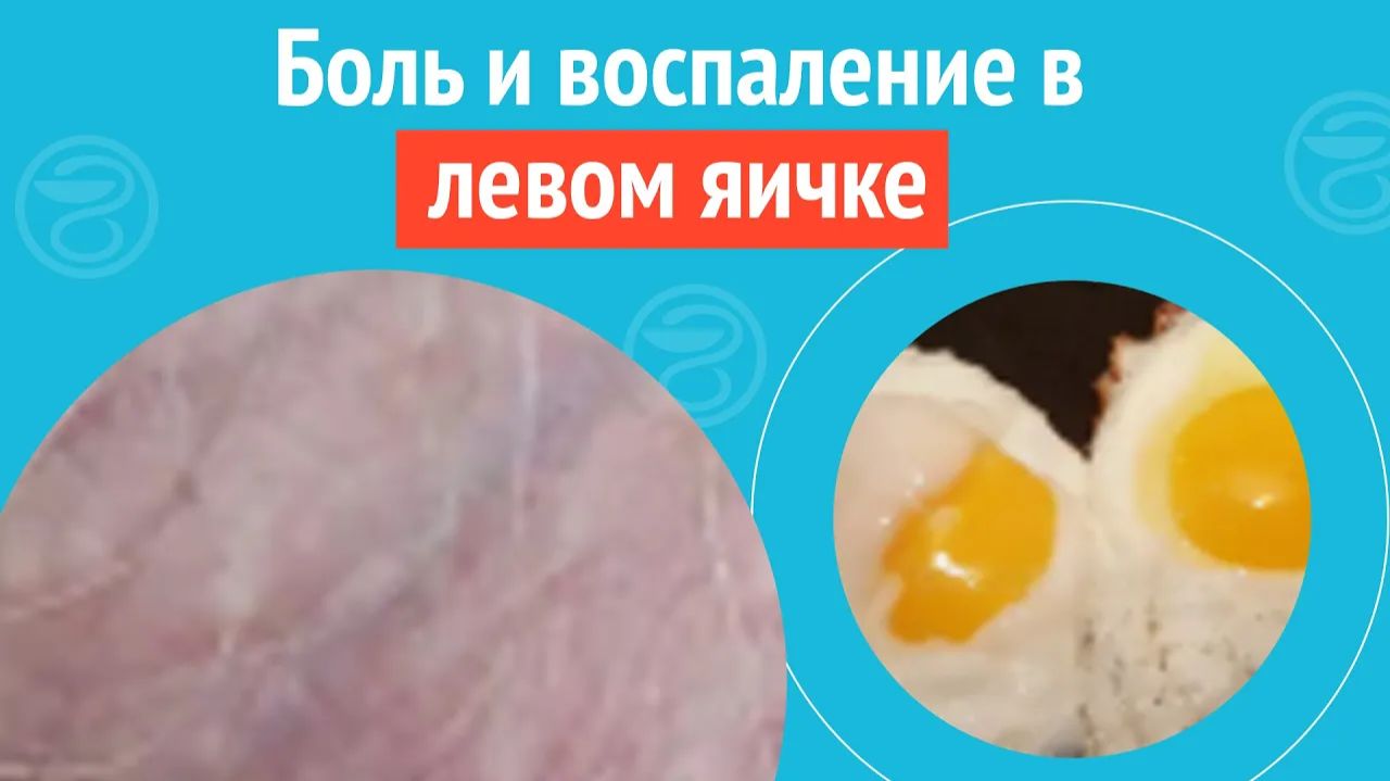 😠 Боль и воспаление в левом яичке. Клинический случай №1678