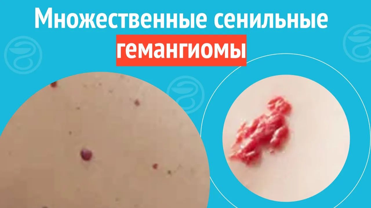 ☹️ Множественные сенильные гемангиомы. Клинический случай №1672