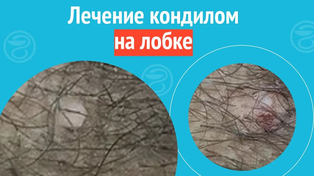 💊 Лечение кондилом на лобке. Клинический случай №1679