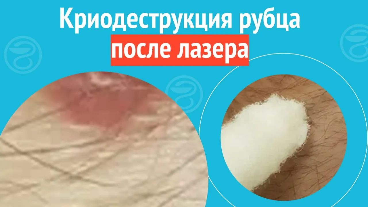 ➡️ Криодеструкция рубца после лазера. Клинический случай №1690