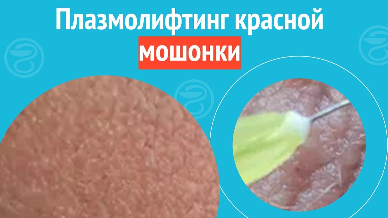 ✅ Плазмолифтинг красной мошонки. Клинический случай №1691