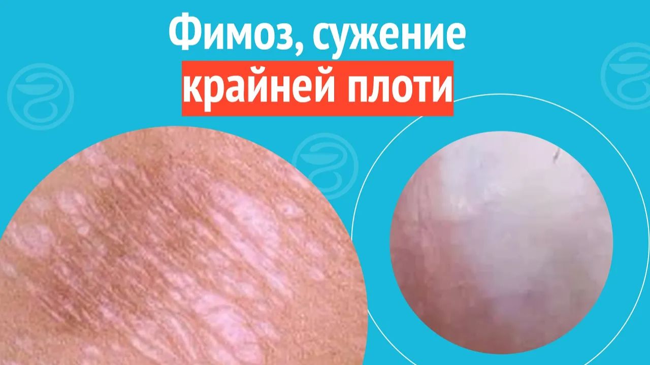 😨 Фимоз, сужение крайней плоти. Клинический случай №1689