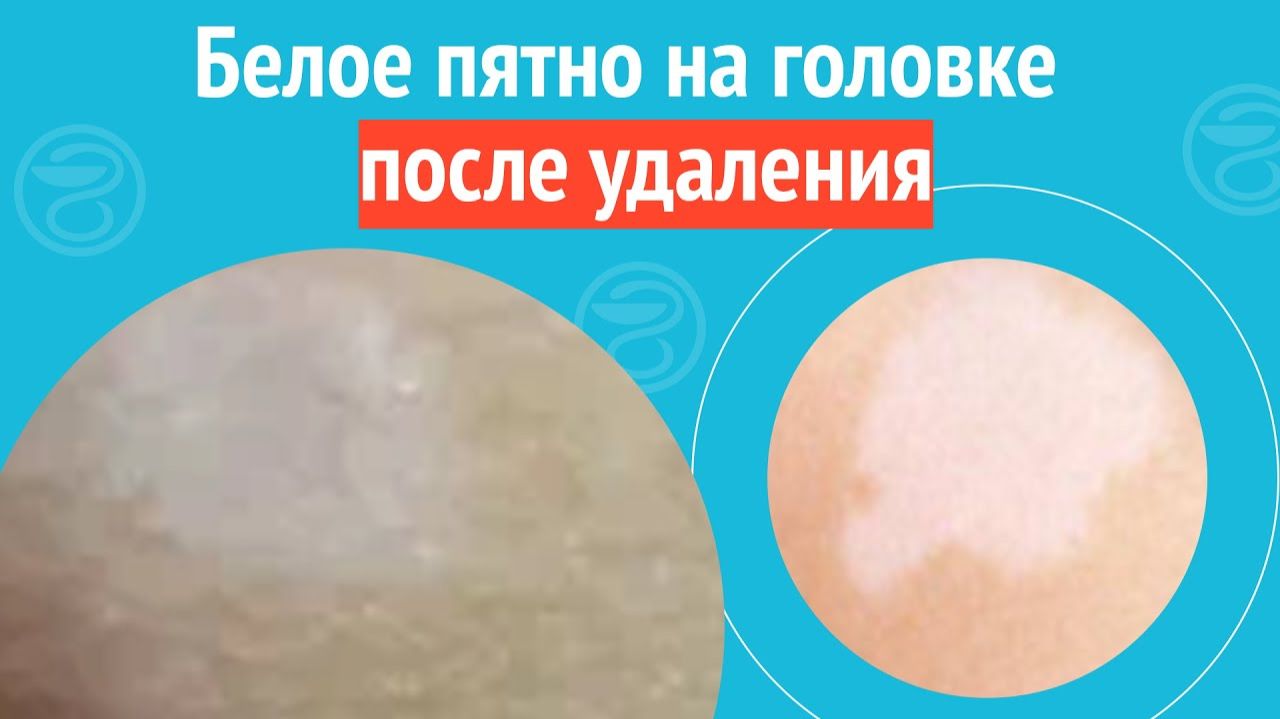 😕 Белое пятно на головке после удаления. Клинический случай №1692