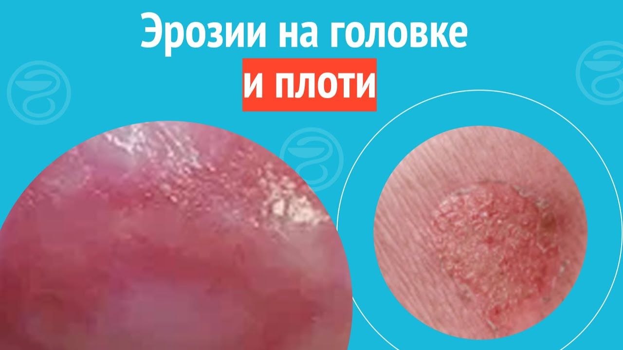 🥺 Эрозии на головке и плоти. Клинический случай №1694