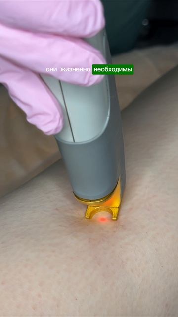 После удаления лазером сосуды снова возвращаются: правда или миф?