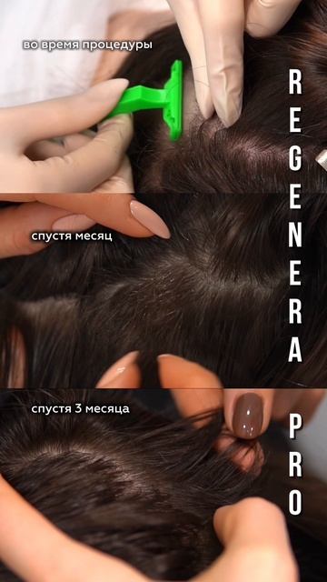 Иновационное востановление волос процедура Regenera Activ