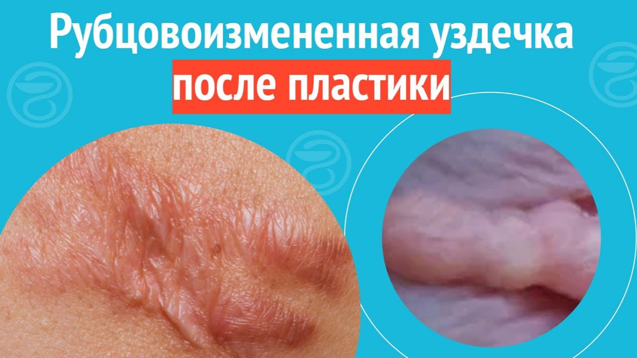 😧 Рубцовоизмененная уздечка после пластики. Клинический случай №1480