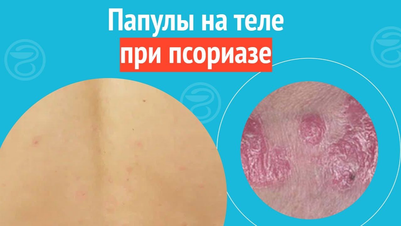 ➡️ Папулы на теле при псориазе. Клинический случай №1490