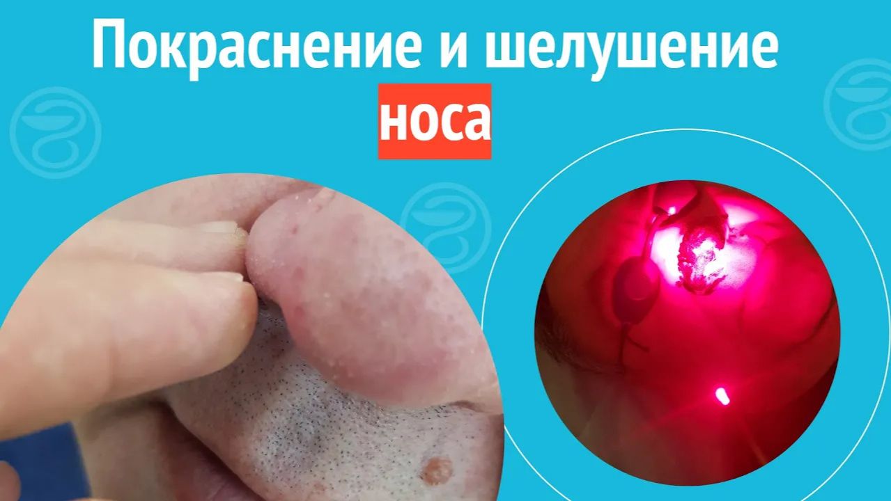 👃 Покраснение и шелушение носа. Клинический случай №1506