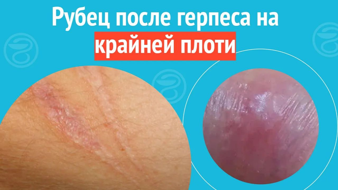 ➡️ Рубец после герпеса на крайней плоти. Клинический случай №1499
