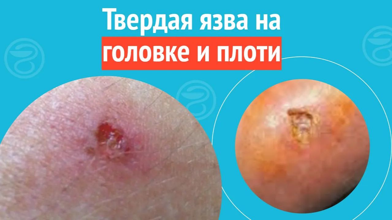 👉 Твердая язва на головке и плоти. Клинический случай №1504