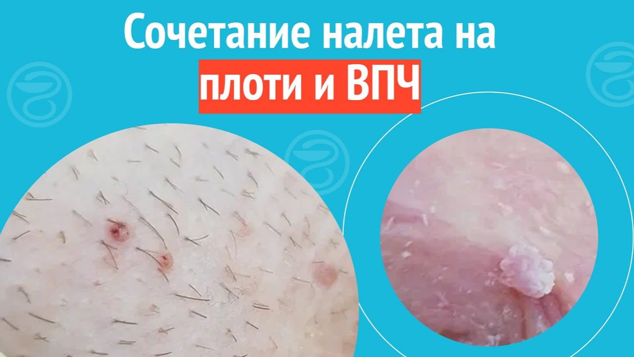 👉 Сочетание налета на плоти и ВПЧ. Клинический случай №1474