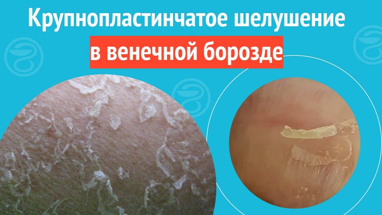 ▶️ Крупнопластинчатое шелушение в венечной борозде. Клинический случай №1482